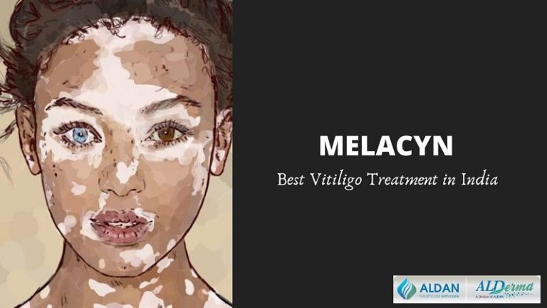 Best Vitiligo Treatment in World | Permanent Vitiligo Treatment For Face